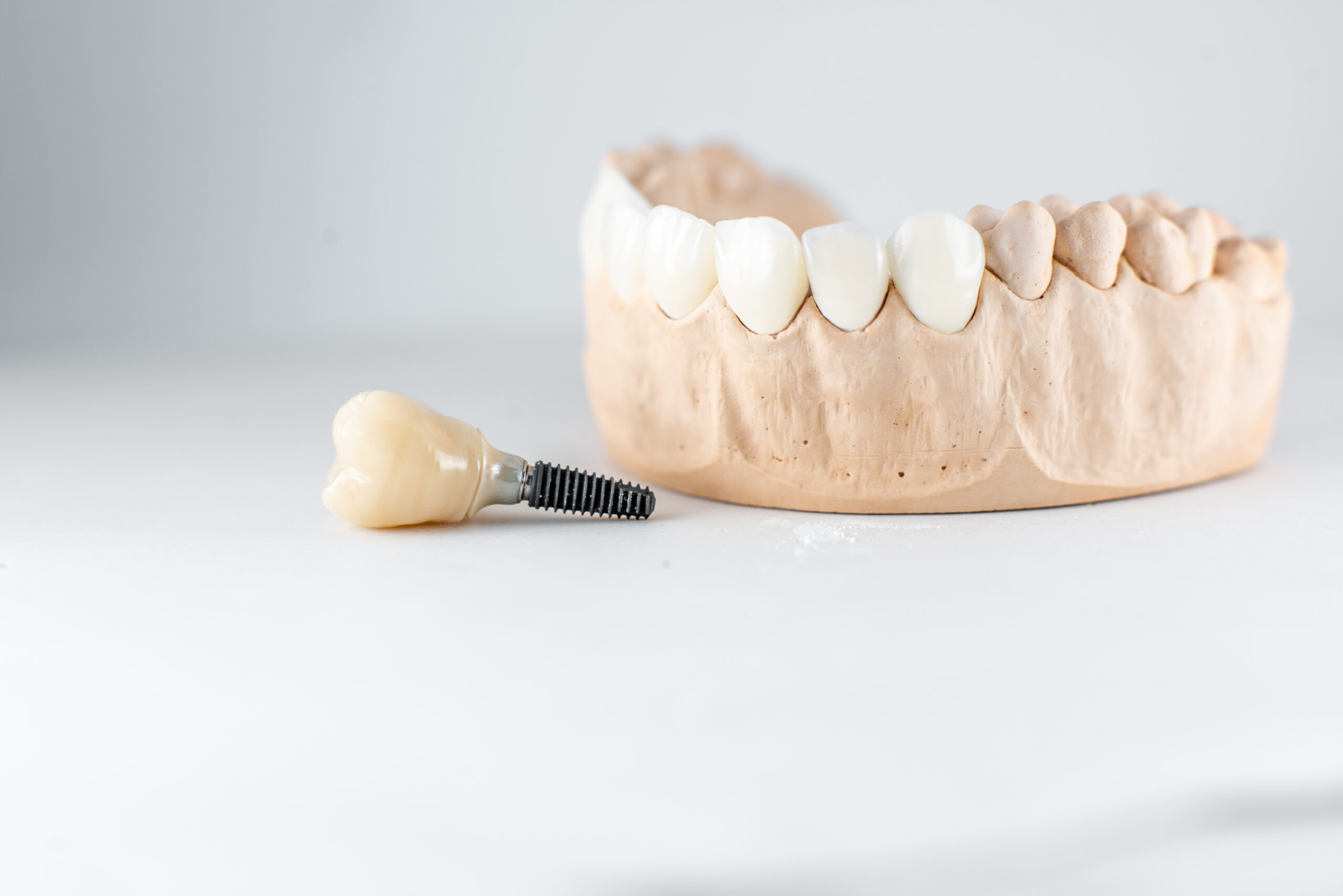 Creating Custom Dental Implant Restorations | West Allis, WI
