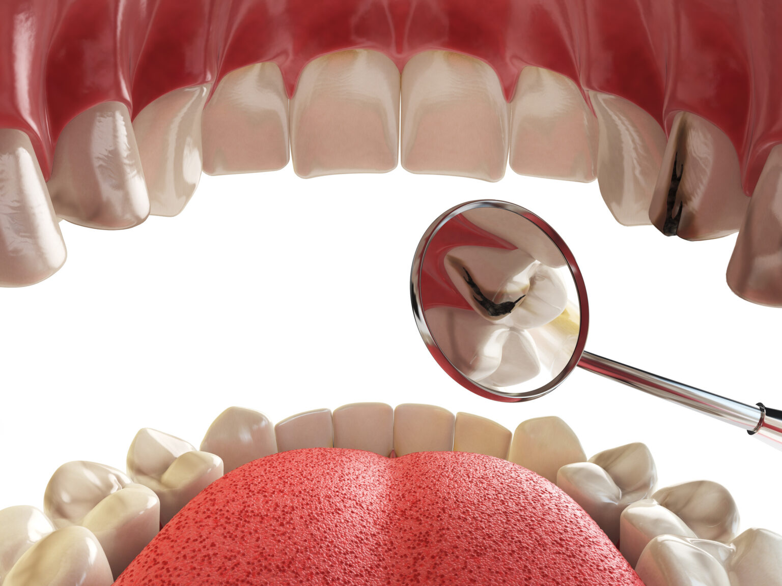 When Does A Tooth Need To Be Extracted? | West Allis, WI